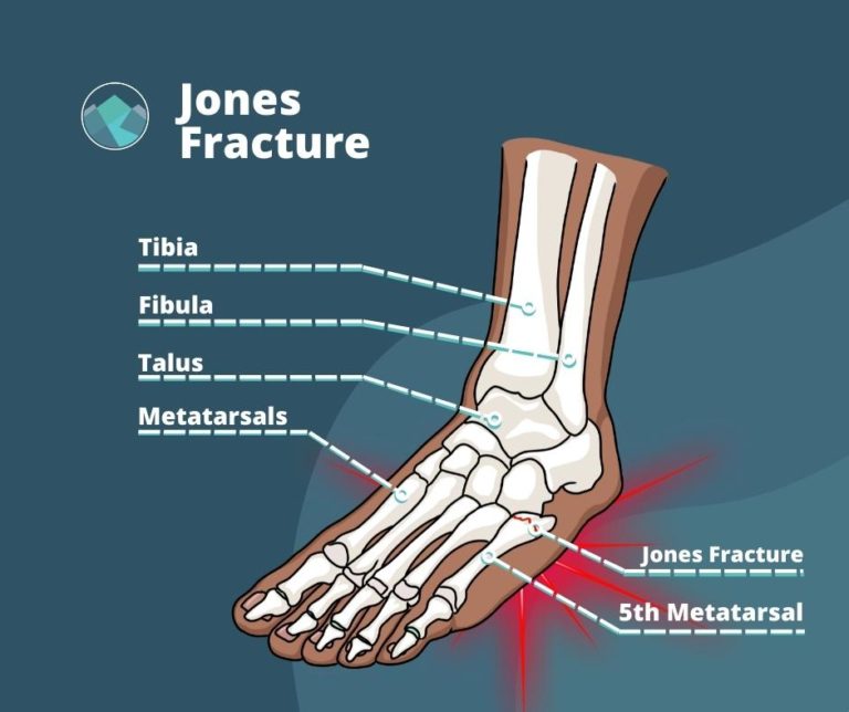 Jones Fracture - UWS Connected Whole Health - UWS Connected Whole Health