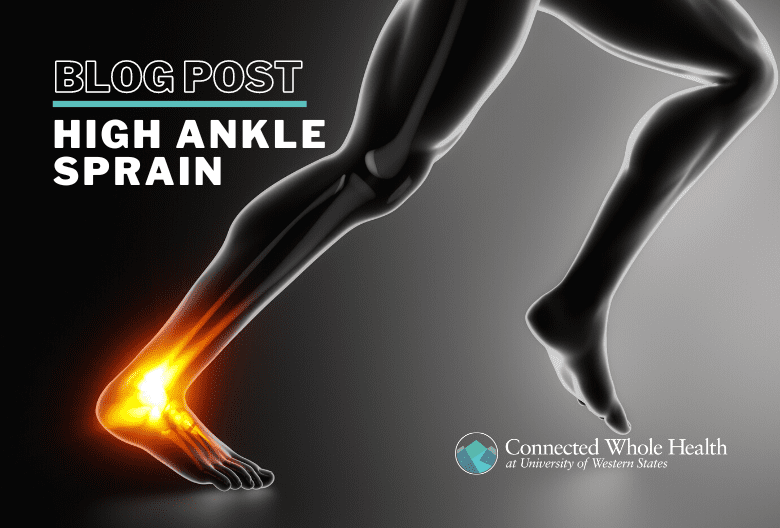 High Ankle Sprain - UWS Connected Whole Health - UWS Connected Whole Health